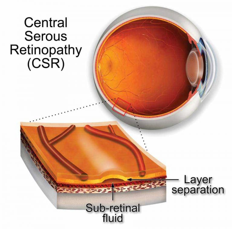 Central Serous Retinopathy – Double Helical
